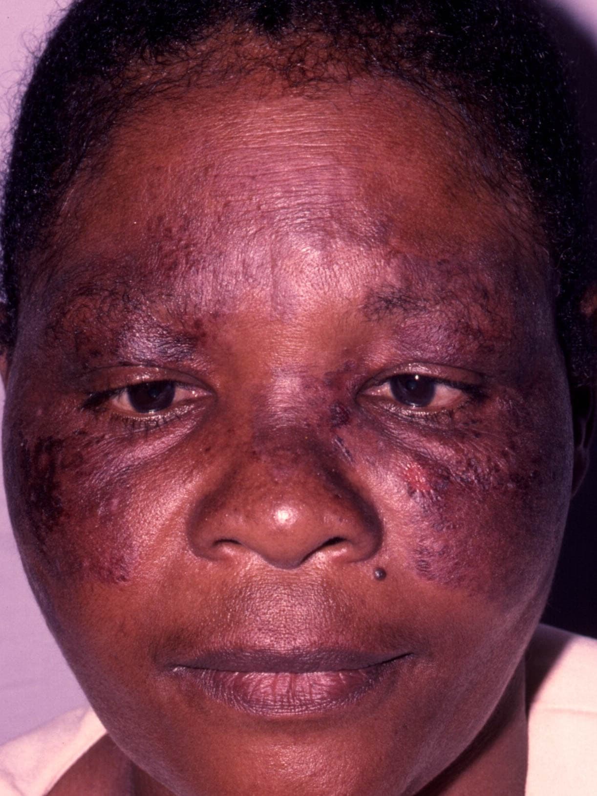 Rosacea | British Skin Foundation